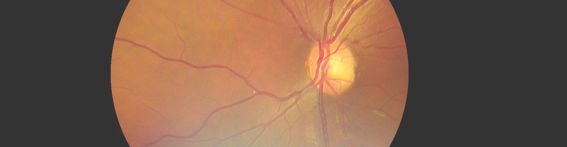 Non Mydriatic Fundus Camera - Competitive Distributor Price