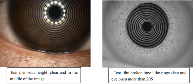 Slit Lamp For Dry Eye Exam - Factory Price